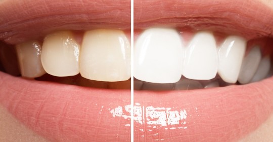 Reasons for Tooth Stains